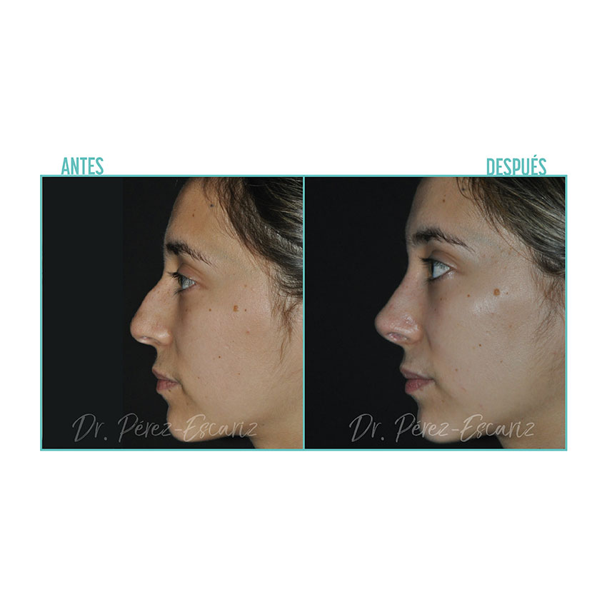 Rinoplastia ultrasónica con disección subpericóndrica