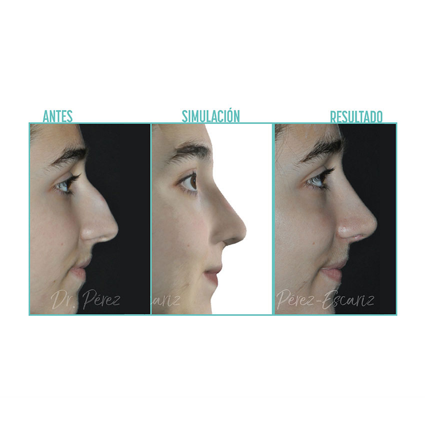 Rinoplastia ultrasónica estructural