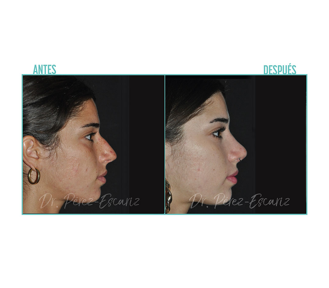 Rinoplastia ultrasónica