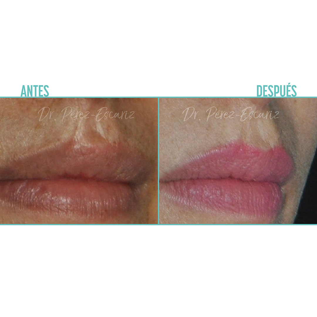 Rinoplastia secundaria y z-plastia en el labio