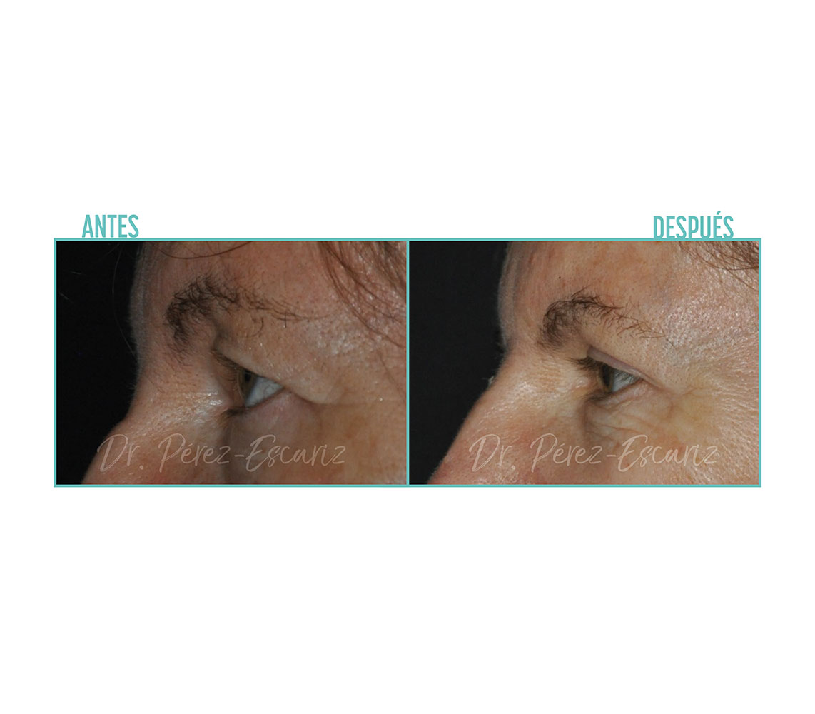 Blefaroplastia