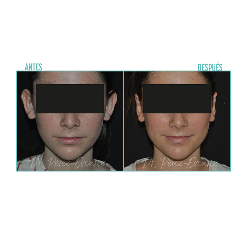 Otoplastia bilateral