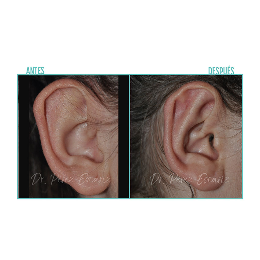 Otoplastia bilateral