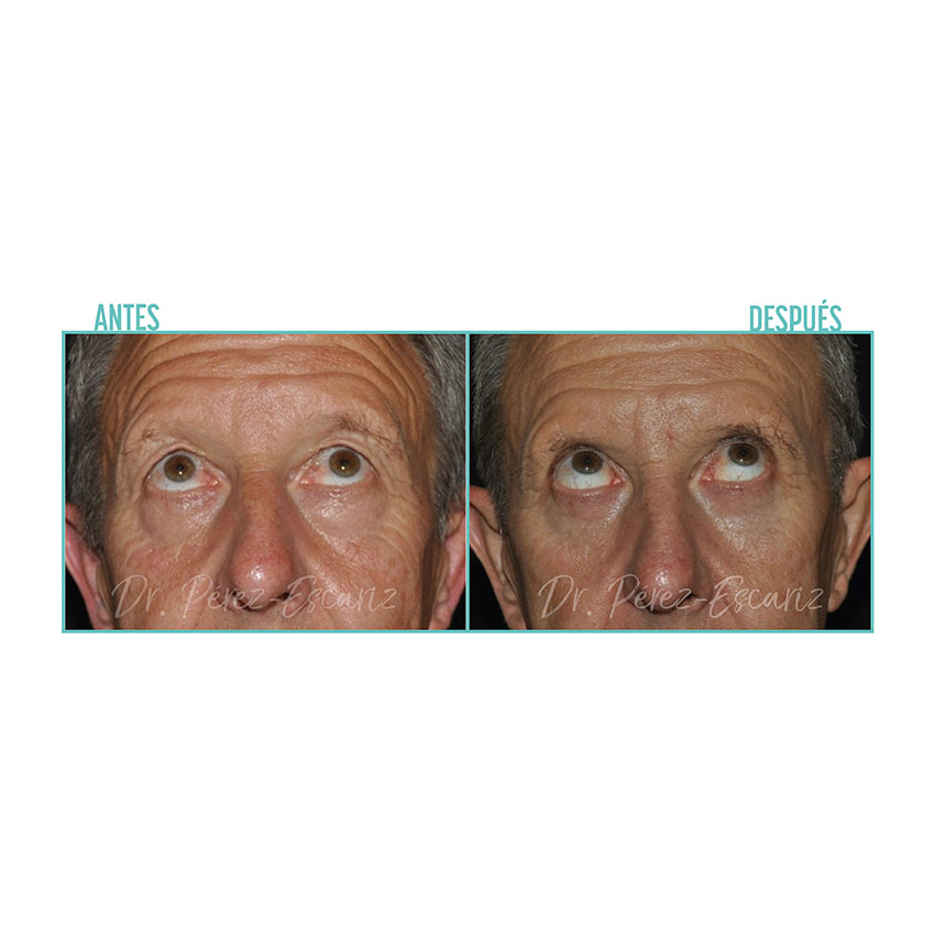 Blefaroplastia completa