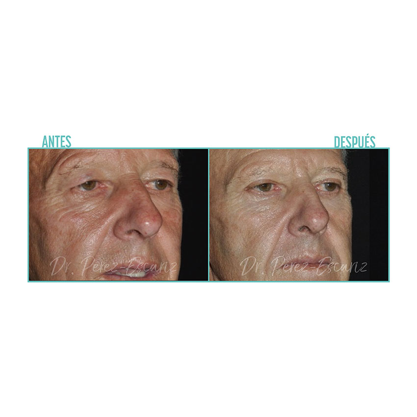 Blefaroplastia completa